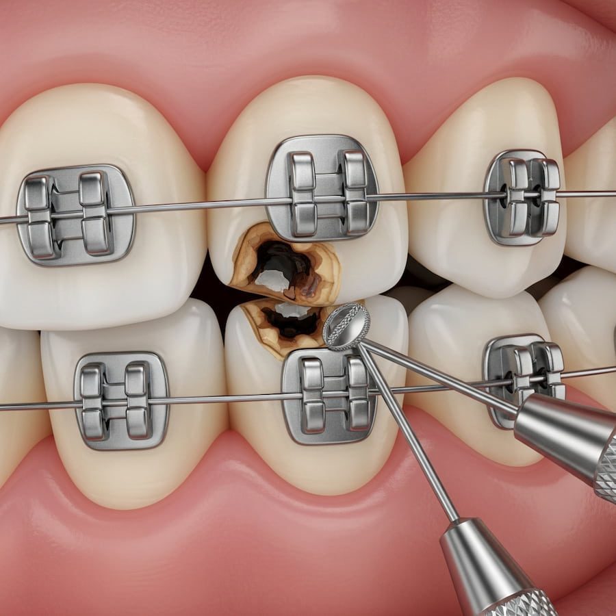 Treatment of tooth decay during orthodontic treatment Causes and Prevention